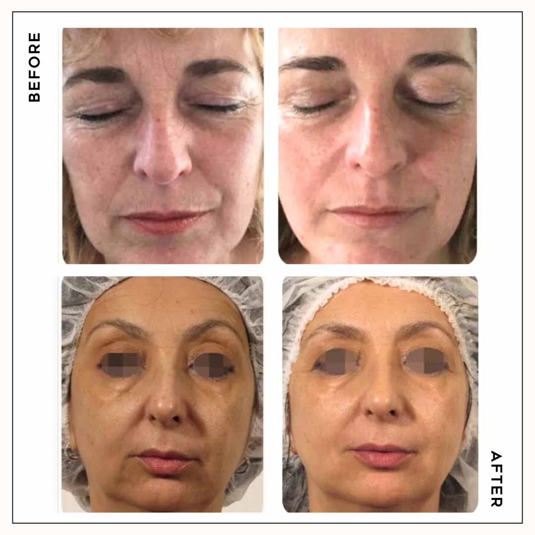 Glo2Facial - Mirabelle Aesthetics & Wellness Clinic